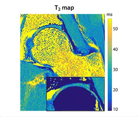 A T2 Map Generated With The Echo Modulation Curve Emc Algorithm For A