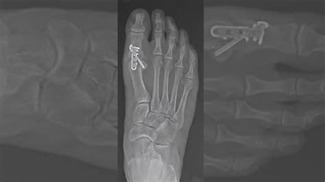 Understanding 1st Mtp Joint Fusion With Locking Plate A Guide For Patients