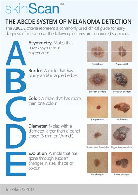What Are The Signs Of Cancerous Mole