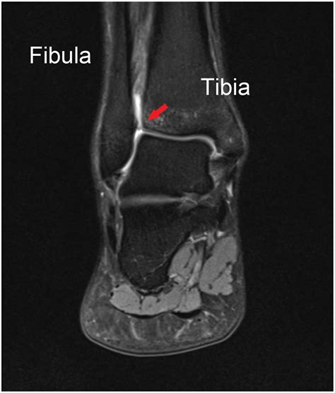Instability Of The Distal Tibiofibular Syndesmosis Rajeev Vohra