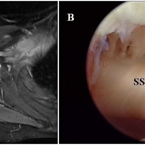 Torn Subscapularis Tendon Without Retraction In The Right Shoulder Of A Download Scientific