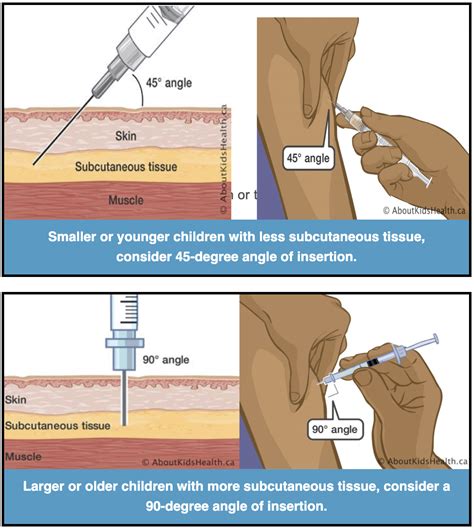Subcutaneous Injection Technique
