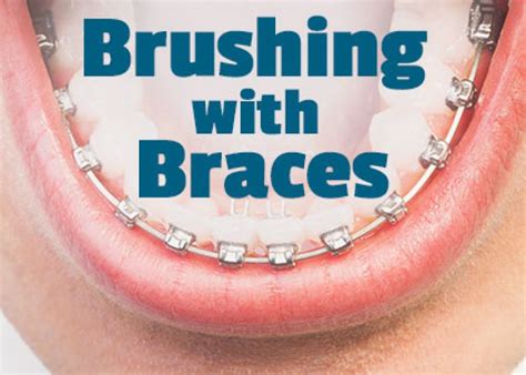 Brushing With Braces In Atlanta Dr Caroline Ceneviz