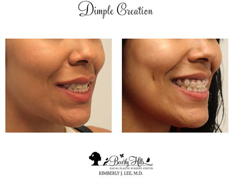 Dimple Creation Before And After Photos Dr Kimberly Lee