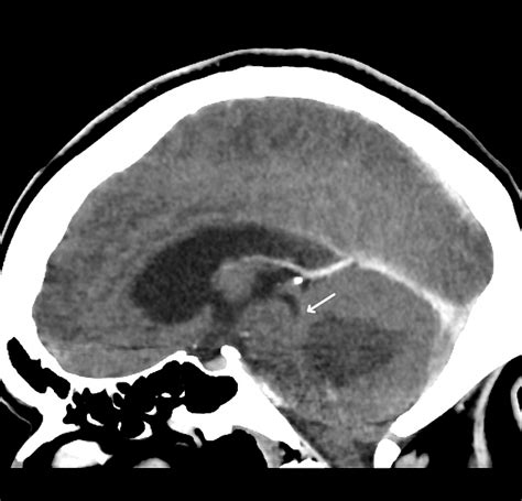 Central Herniation Radiopaedia