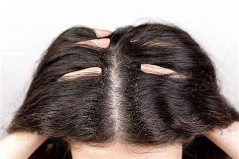 What Causes Dandruff In Hair