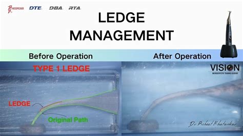 🦷 【 Ledge Bypassing Case 】 ⚙️ Youtube
