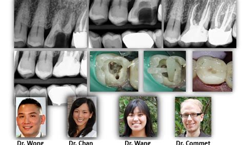 Compromised Teeth Factors Involved Renovo Endodontic Studio