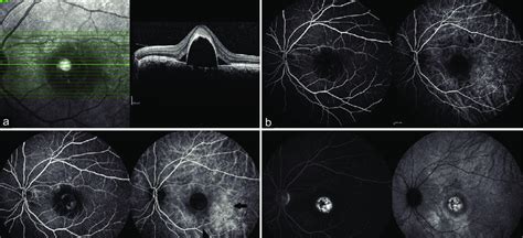 Optical Coherence Tomography Of Chronic Central Serous Download