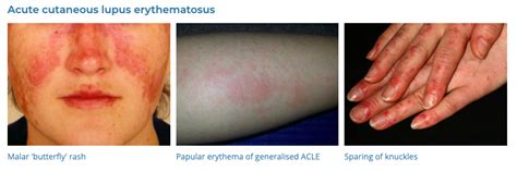 Sle Systemic Lupus Erythematosus Gp Exams