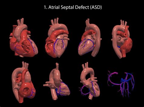 Congenital Heart Disease 7pack 3d Model Cgtrader