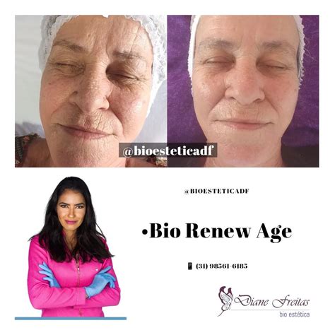 🦋 Antes E Depois 🦋 Amamos Te Diane Freitas Bio Estética Facebook