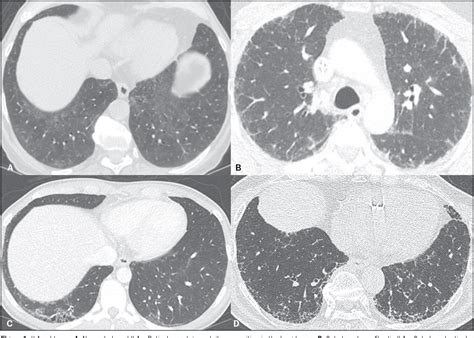 Figure 1 From “interstitial Lung Abnormalities” Translation To And Use