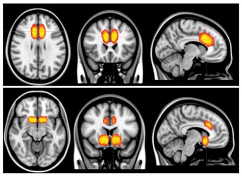 Lesion Analysis For Cingulotomy And Limbic Leucotomy Comparison And