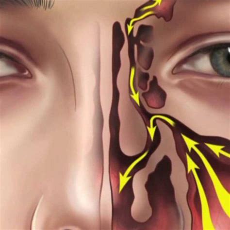 Endoscopic Sinus Surgery Ess Op Dr Turgut Yüce