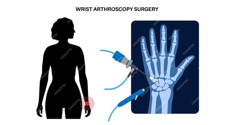 Premium Vector Wrist Arthroscopy Surgery