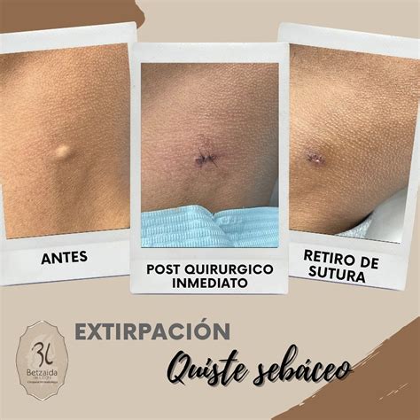 Quiste Sebaceo Infected Sebaceous Cysts Stockfoto En Meer Beelden Van