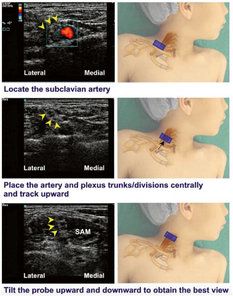Pediatric Atlas Of Ultrasound And Nerve Stimulation Guided Regional