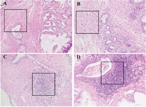 Varying Degrees Of Histological Prostatitis Hande 200 Download