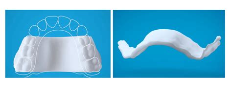 How To Wear Invisalign Palatal Expander Invisalign In Singapore A Complete Guide