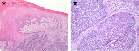 Large Fungating Basal Cell Carcinoma Of The Dorsum Of The Foot A Case