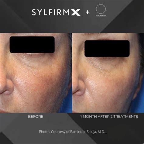 Sylfirm X In Boston Rf Microneedling Boston Medical Aesthetics