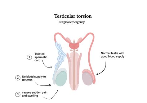 Testicular Torsion Biorender Science Templates Testicular Torsion Biorender Science Templates