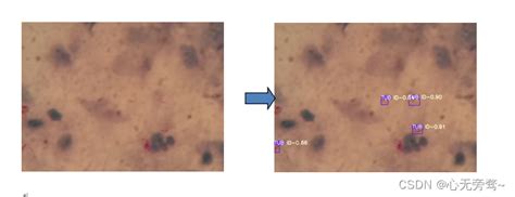 基于yolov8的结核病预测系统设计与实现 yolov8医学图像检测 csdn博客