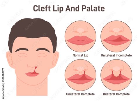 Cleft Lip And Cleft Palate Harelip Human Face With A Birth Defect