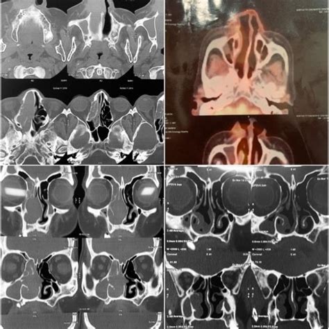 Ct Scans Before A And After Surgery B Draf Iii Procedure Involves Download Scientific
