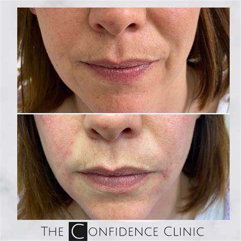 Reduction Of Nasolabial Folds And The Confidence Clinic Facebook