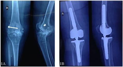 Case 1 A Preoperative Aplateral Knee Radiographs Show Fixed