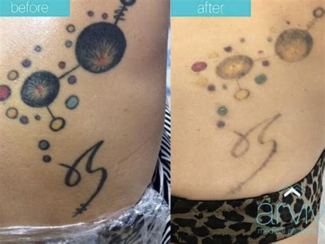 Shallow Vagina Causes And Treatments Guide Arviv Medical Aesthetics