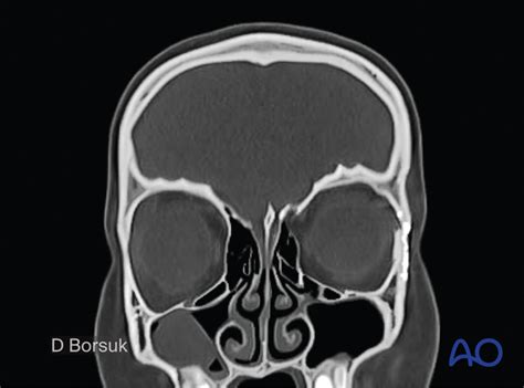 Open Treatment For Lateral Orbital Wall Fracture