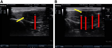 Percutaneous Achilles Tendon Repair Using Ultrasound Guidance An Intraoperative Ultrasound