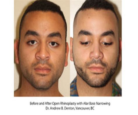 Alar Base Narrowing Vancouver Rhinoplasty Dr Denton