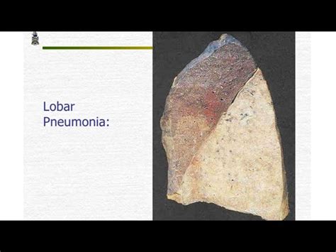 Lobar Pneumonia Gross