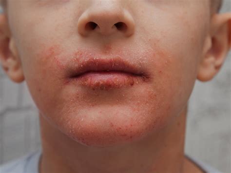 What Causes Perioral Dermatitis Balmonds