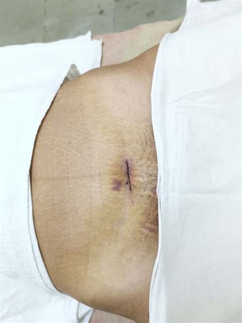 Tubal Re Anastomoses Through A Mini Laparotomy Incision
