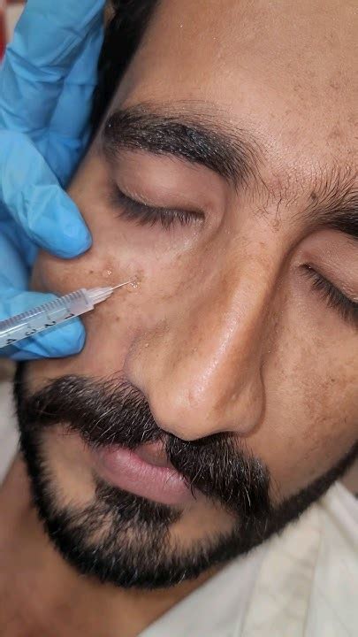 Hyper Pigmentation Injection Tranxemicacid Hyperpigmentation Beauty