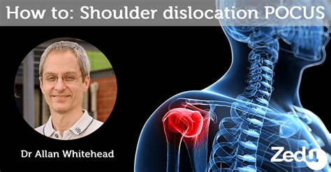 How To Shoulder Dislocation Pocus Ultrasound Training
