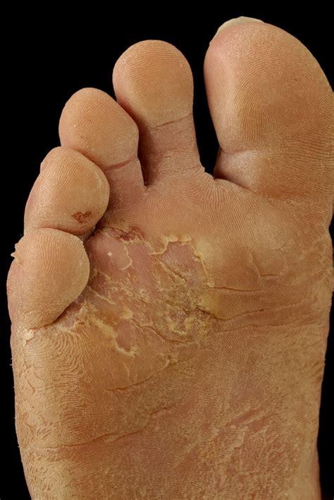 Epidermolytic Palmoplantar Keratoderma Palmoplantar Keratoderma And Pleomorphic Adenoma Of