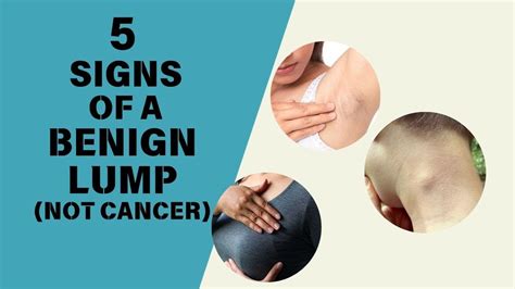 5 Signs That Your Neck Or Armpit Lump Might Not Be Cancer Youtube