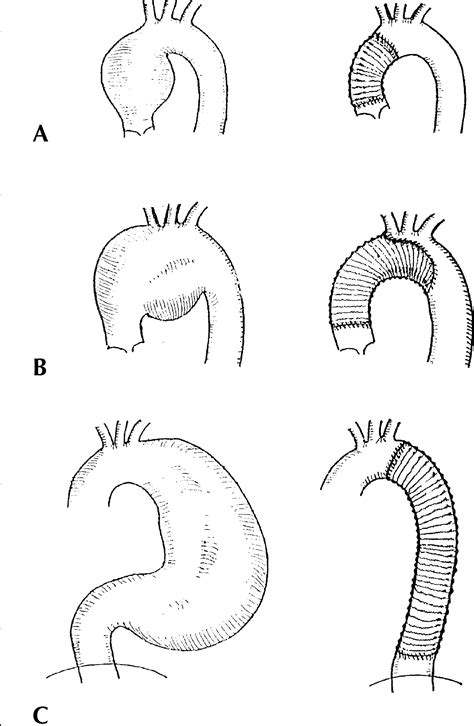 Dissection Vs Rupture At Madalyn Hartley Blog