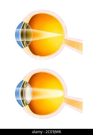 Medical Illustration Of A Cataract In The Human Eye Compared To A