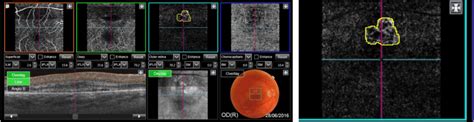 Example Of Images Analysed A Image Of Oct A Showing Cnvm And B Image Download Scientific