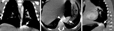 Extralobar Bronchopulmonary Sequestration In A 3 Month Old Girl With A Download Scientific