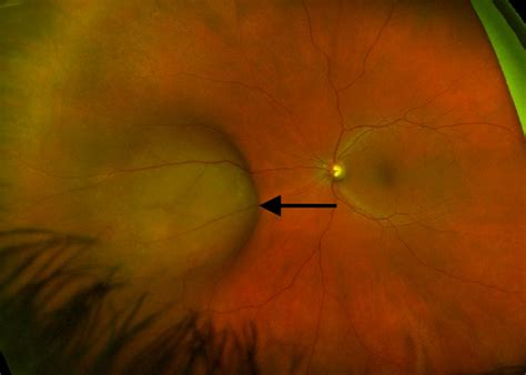 Choroidal Melanoma