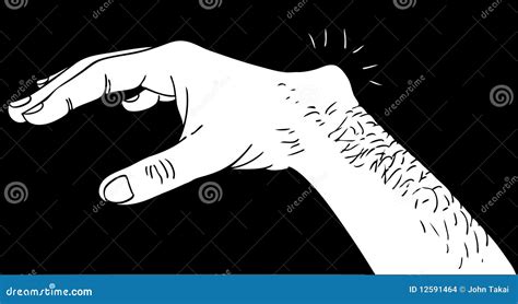 Ganglion Cyst Structure Diagram Medical Science Stock Illustration