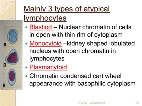 Infectious Nucleosis Jtvpathokmc Ppt